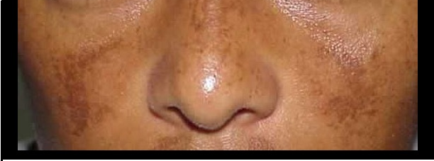 Melasma. Você sabe o que é?