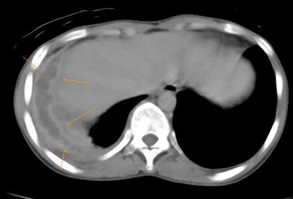 Split Pleura Sign-CT - Sumer's Radiology Blog