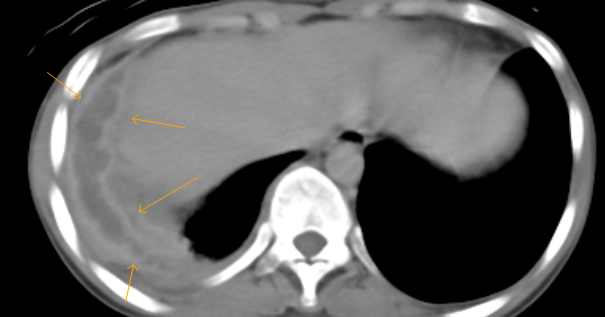 Split Pleura Sign-CT - Sumer's Radiology Blog