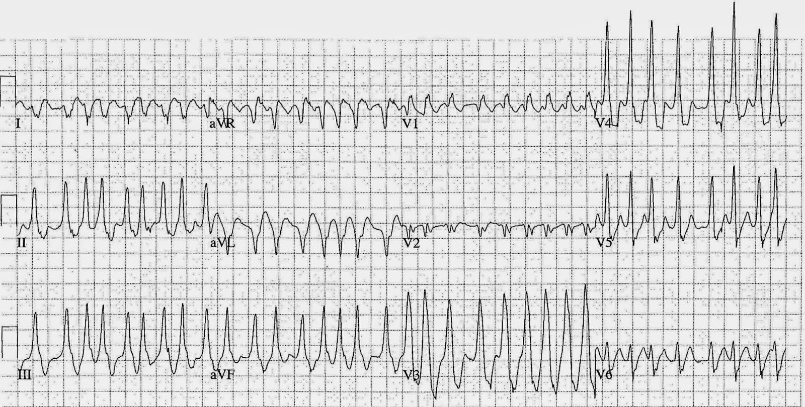 ECG of the Week: ECG of the Week - 28th October 2013 - Interpretation