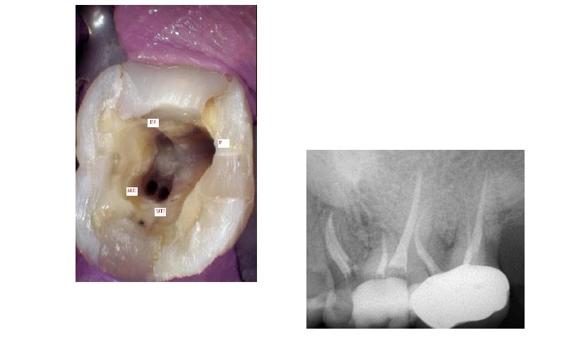 Root Canal Treatment Endodontic Treatment Of Maxillary 1st Molar With