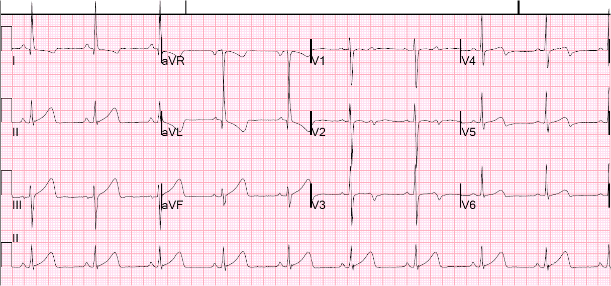Dr. Smith's ECG Blog: ST changes due to limb lead LVH?