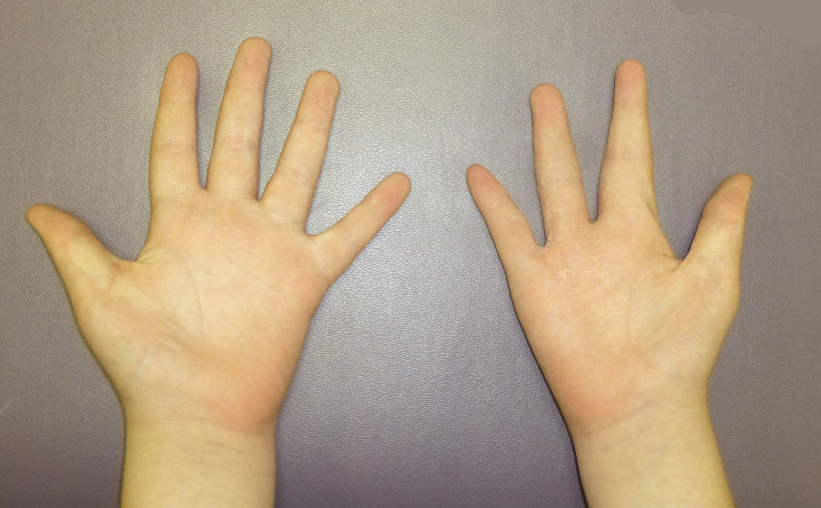 Cleft Hand Long Term Follow- up | Congenital Hand and Arm Differences ...