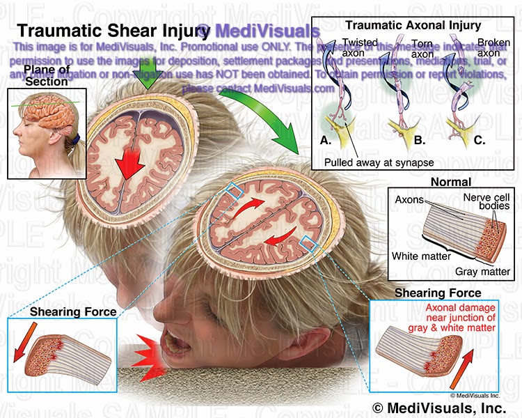 The Medical Legal Exhibit Expert Blog: Understanding Traumatic Brain ...