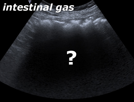 CamRadTech: Ultrasound Intestines