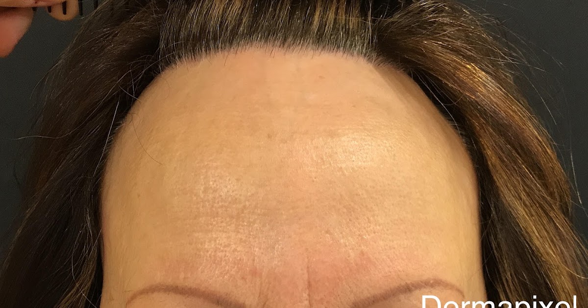 Dermapixel: Tengo la frente cada vez más grande
