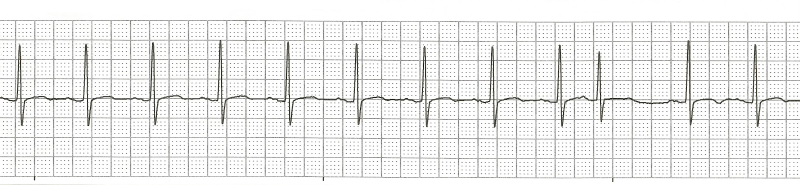 EKG Rhythm Strip Quiz 82
