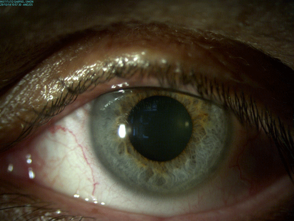 CENTRO ÓPTICO ALOMAR BARCELONA: ANISOCORIA