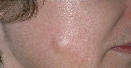 QUISTE SEBÁCEO: UNA INOFENSIVA PERO INESTÉTICA PROTUBERANCIA ~ DR ...