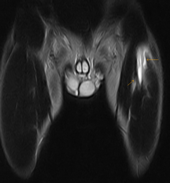 Rectus femoris Tear-MRI - Sumer's Radiology Blog
