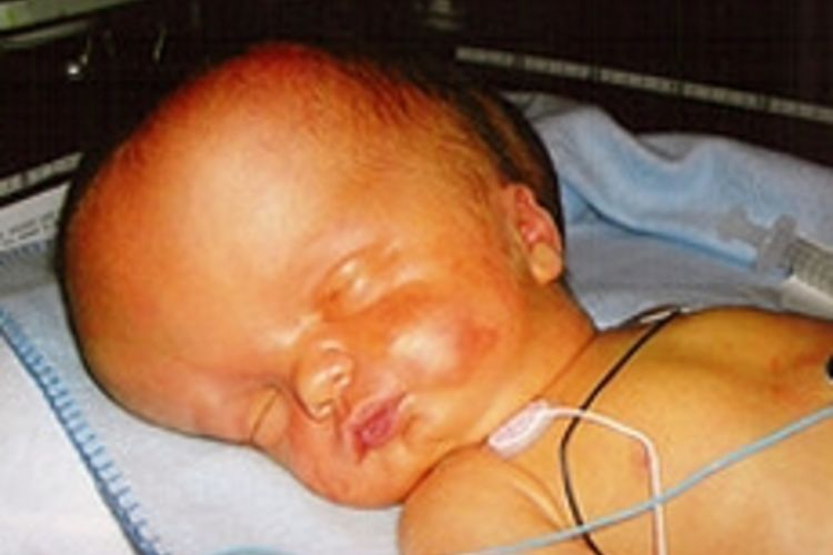 Buasir Otak: Kenali penyakit kepala air atau Hydrocephalus