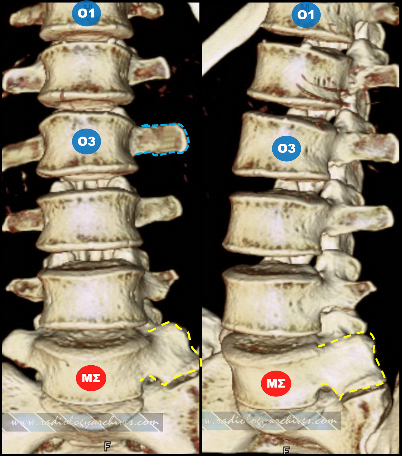 Radiology Archives: Μεταβατικός Oσφυοϊερός Σπόνδυλος - Οσφυοποίηση Ι1 ...