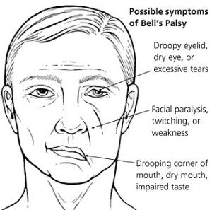 PG Medic: Stroke vs Bell`s Palsy