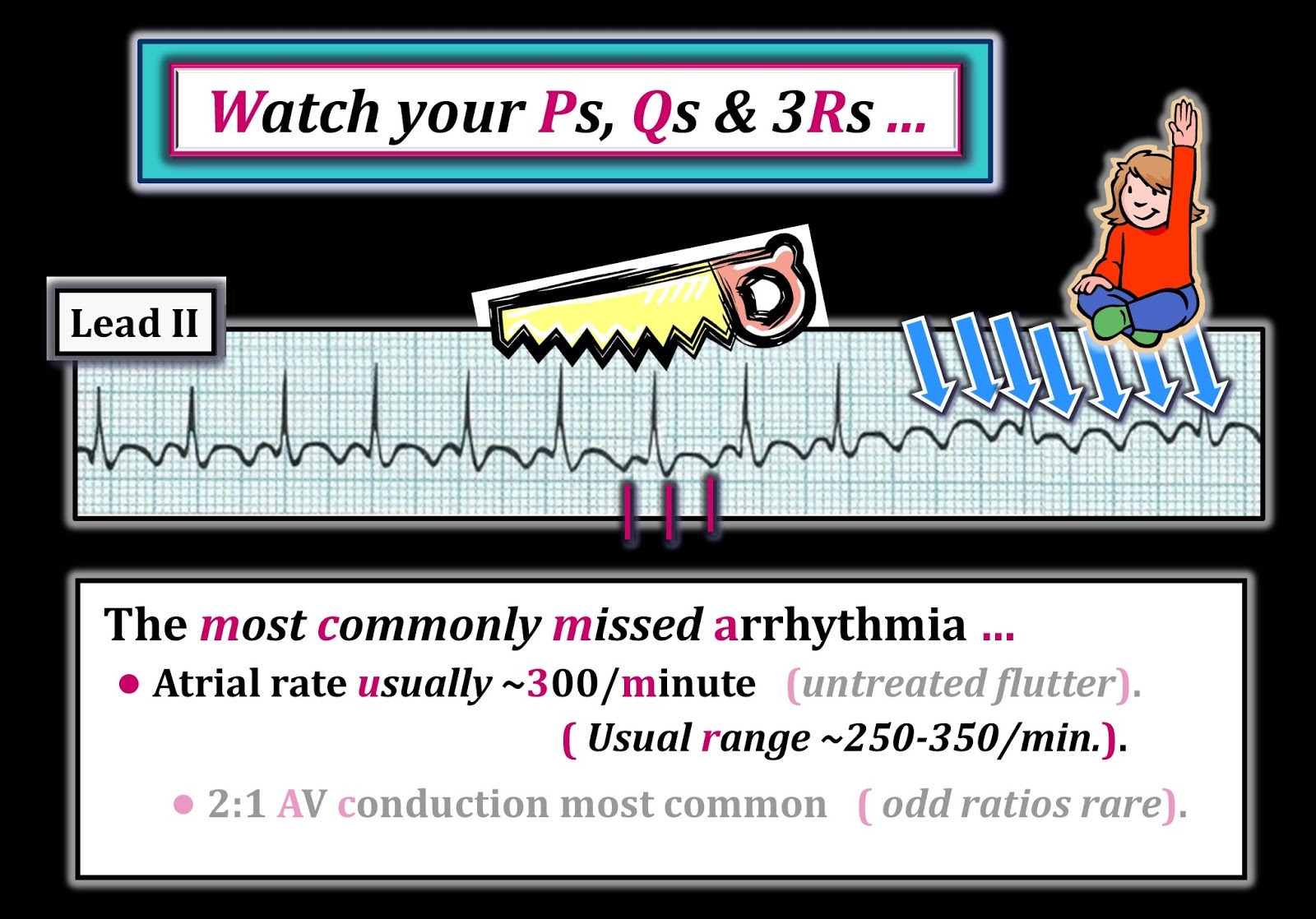 ECG Interpretation: ECG Blog #113 (ECG Video-Blogs-10,11,12) - Rhythm ...