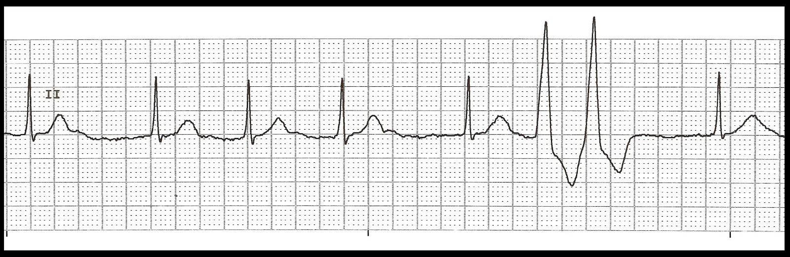 EKG Quiz 344