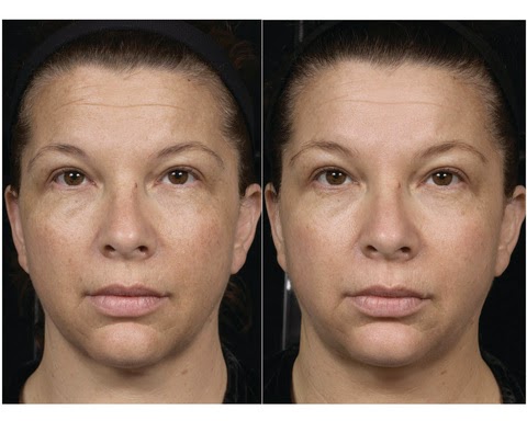 Perfect Body Laser and Aesthetics: CLEAR + BRILLIANT