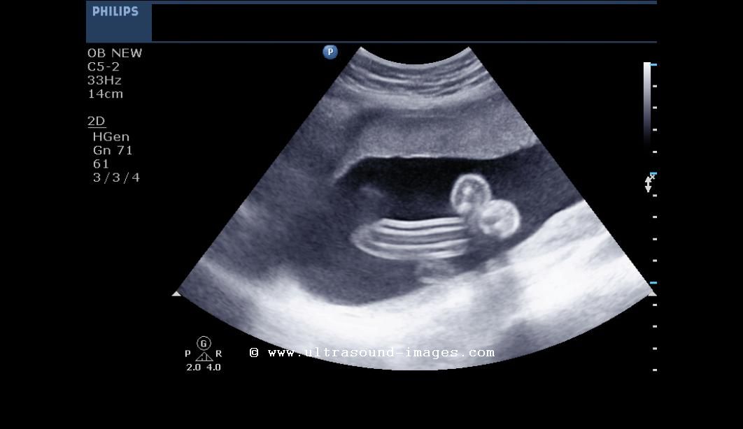 cochinblogs: Pregnancy with fibroid and hypocoiled cord: