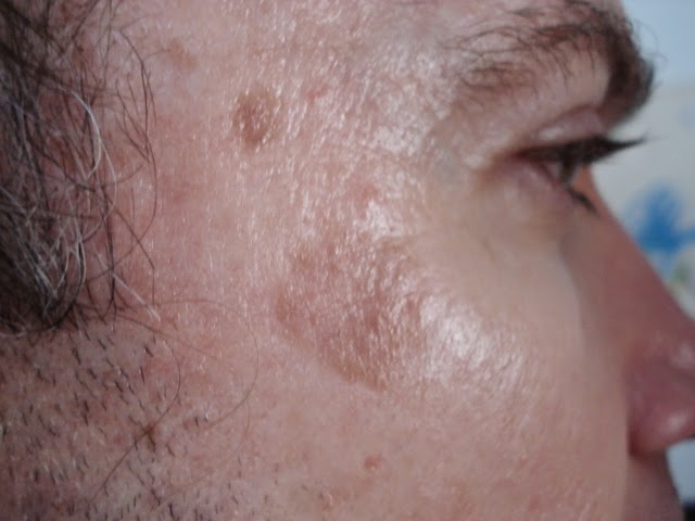 SKIN DISEASE TYPES: Seborrheic Keratosis (Skin Disease Type)