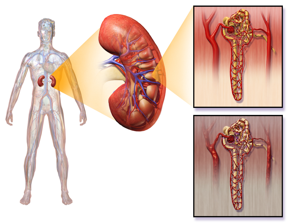 Renal disease Good News Treatment For Patients With Diabetes Nephropathy renal-disease-good-news-treatment-for-patients-with-diabetes-nephropathy