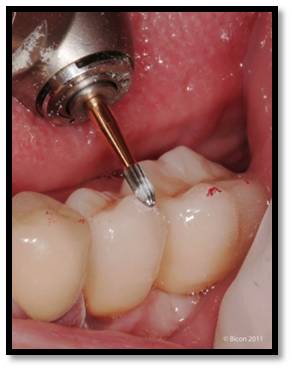 Blog Rasmi Bahagian Kesihatan Pergigian Negeri Perlis: Perkhidmatan ...