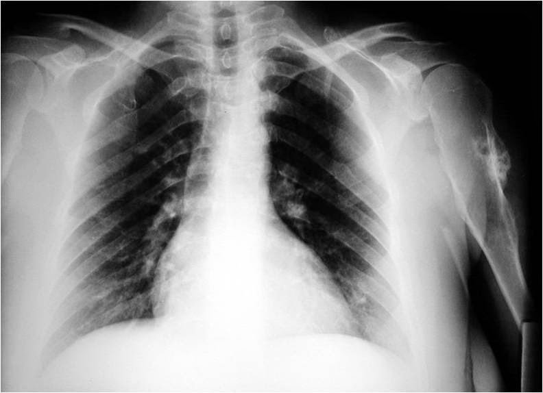 RADIOLOGY IMAGE SPOTTERS: Exostosis rib and humerus