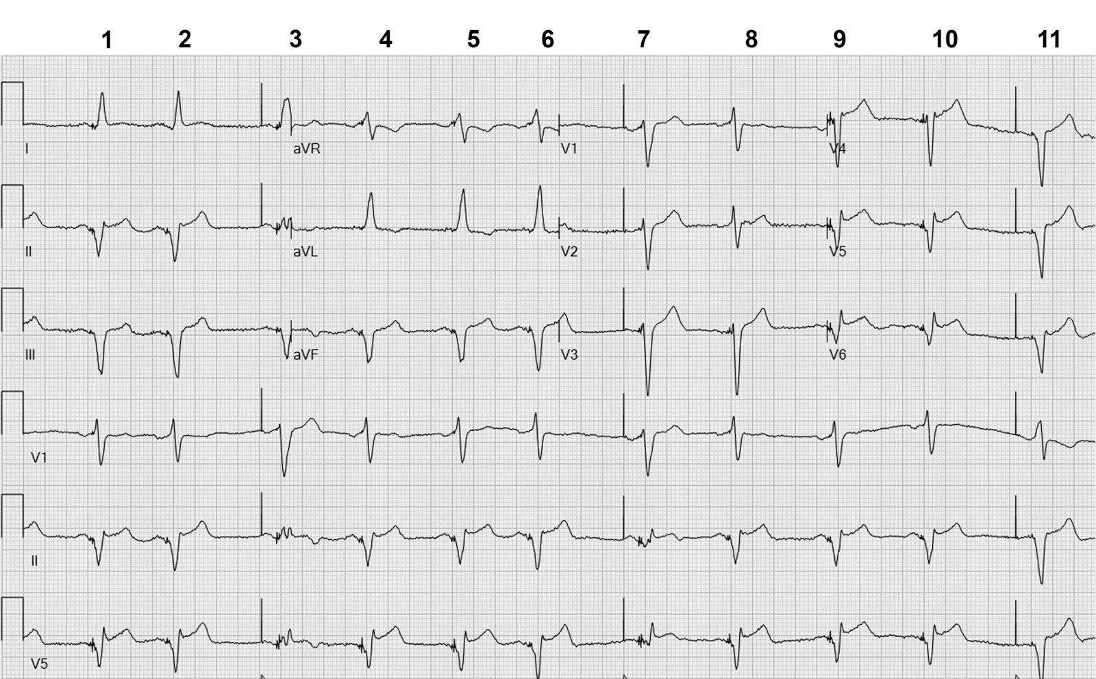 Focus on ECGs: Case #12 — Varying Morphology of QRS Complexes: A ...
