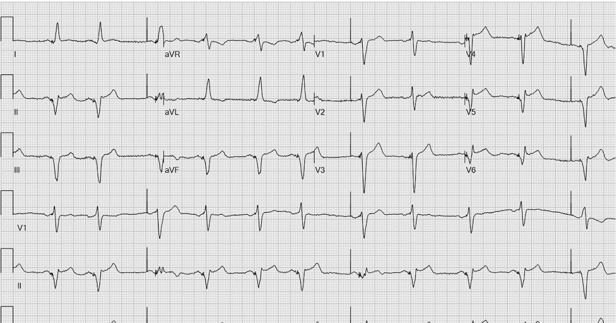 Focus on ECGs: Case #12 — Varying Morphology of QRS Complexes: A ...