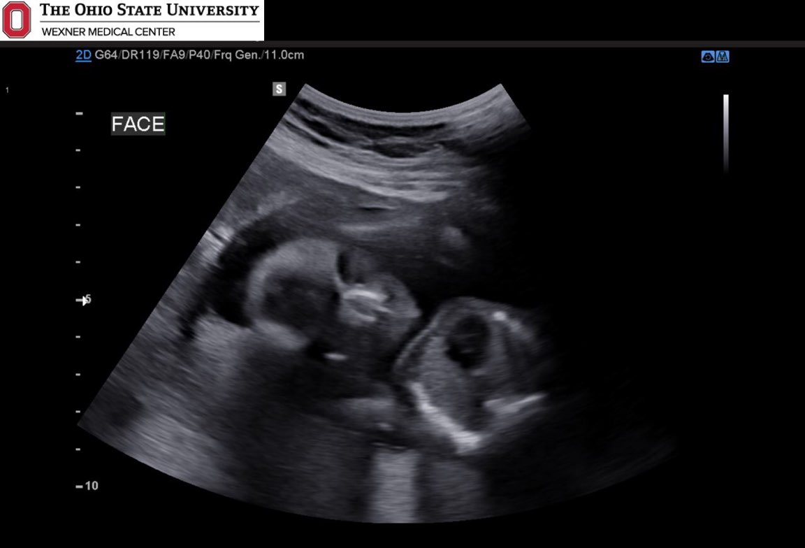 BARNETT BABY: 18 WEEK ULTRASOUND!!!