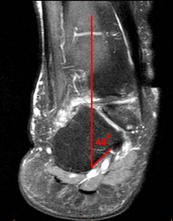 MRI Musculo-Skeletal Section: Lateral hindfoot impingement.
