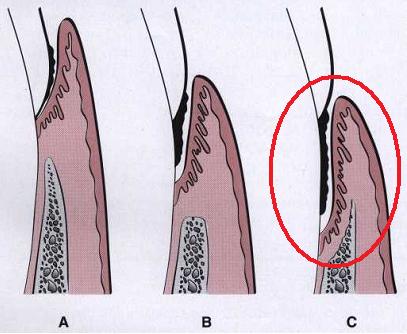 Dentistry lectures for MFDS/MJDF/NBDE/ORE: A NOTE ON CLASSIFICATION ...
