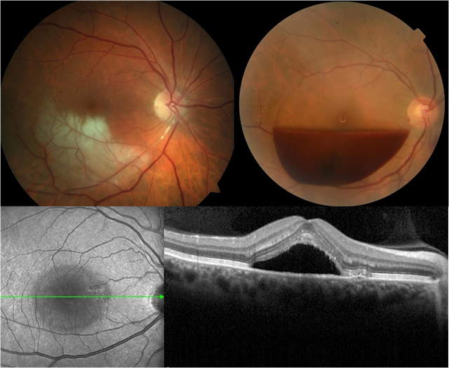 Retina e Catarata - Fortaleza: Retinografia
