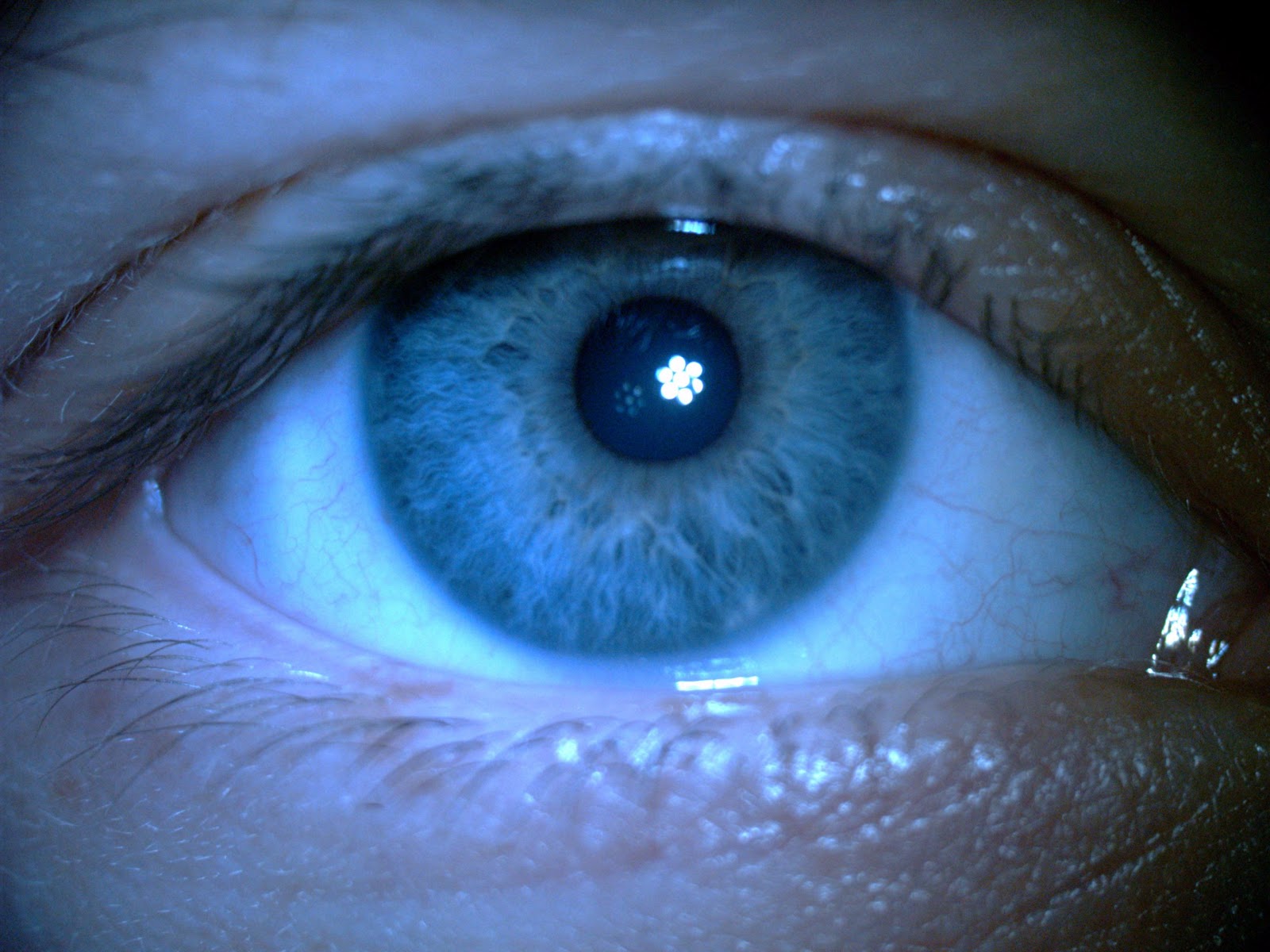 Vernon's Vision: CORNEAL ARCUS