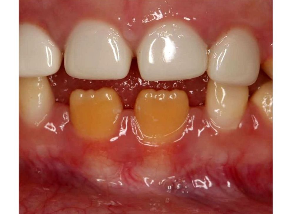 ORAL PATHOLOGY : Pre-eruptive causes for intrinsic discoloration ...
