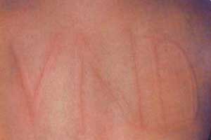 الارتكاريا ماهي؟ وما علاجها ؟ الشري Urticaria