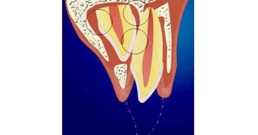ODONTOPEDIATRÍA: Intrusión de dientes primarios por traumatismo - Ovi ...