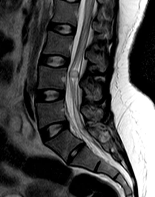 Cauda Equina Tumour-Differentials - Radiology Imaging