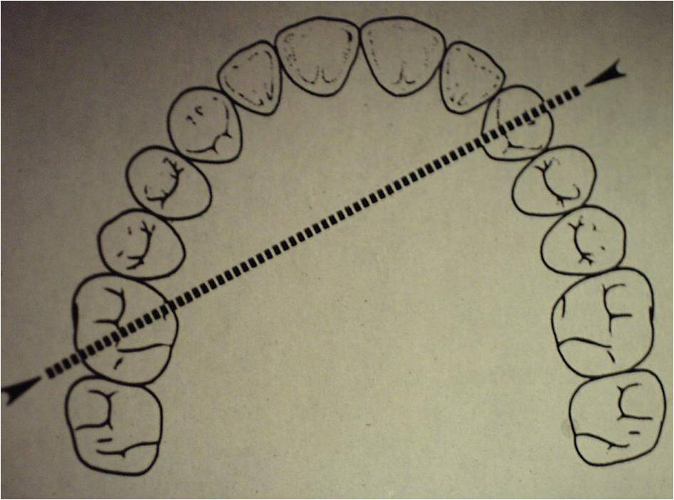 practical orthodontics: Diagnosis and treatment of mesially rotated ...