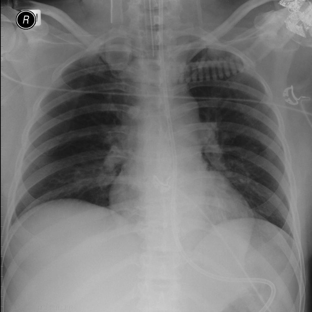 Nos.: Westermark sign