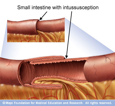 Sudiyatmo,MD Blog & Journal: Invaginasi (Intussusception) pada Dewasa