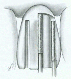 Odontology Student: Prosthodontics: The Metal-Ceramic Crown Preparation ...
