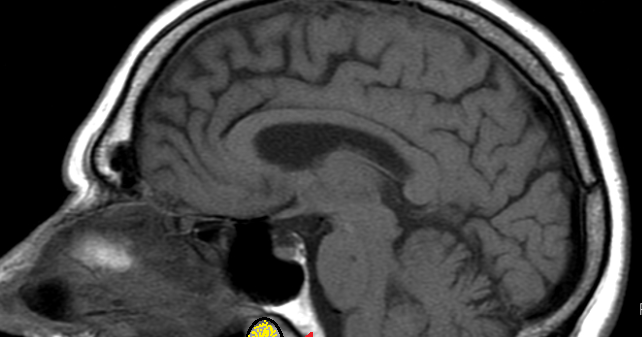 El Baúl Radiológico: QUISTE DE TORNWALDT. BURSA RINOFARÍNGEA (Tornwaldt ...