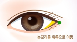 BK Plastic Surgery: Outer corner of eye reshaping