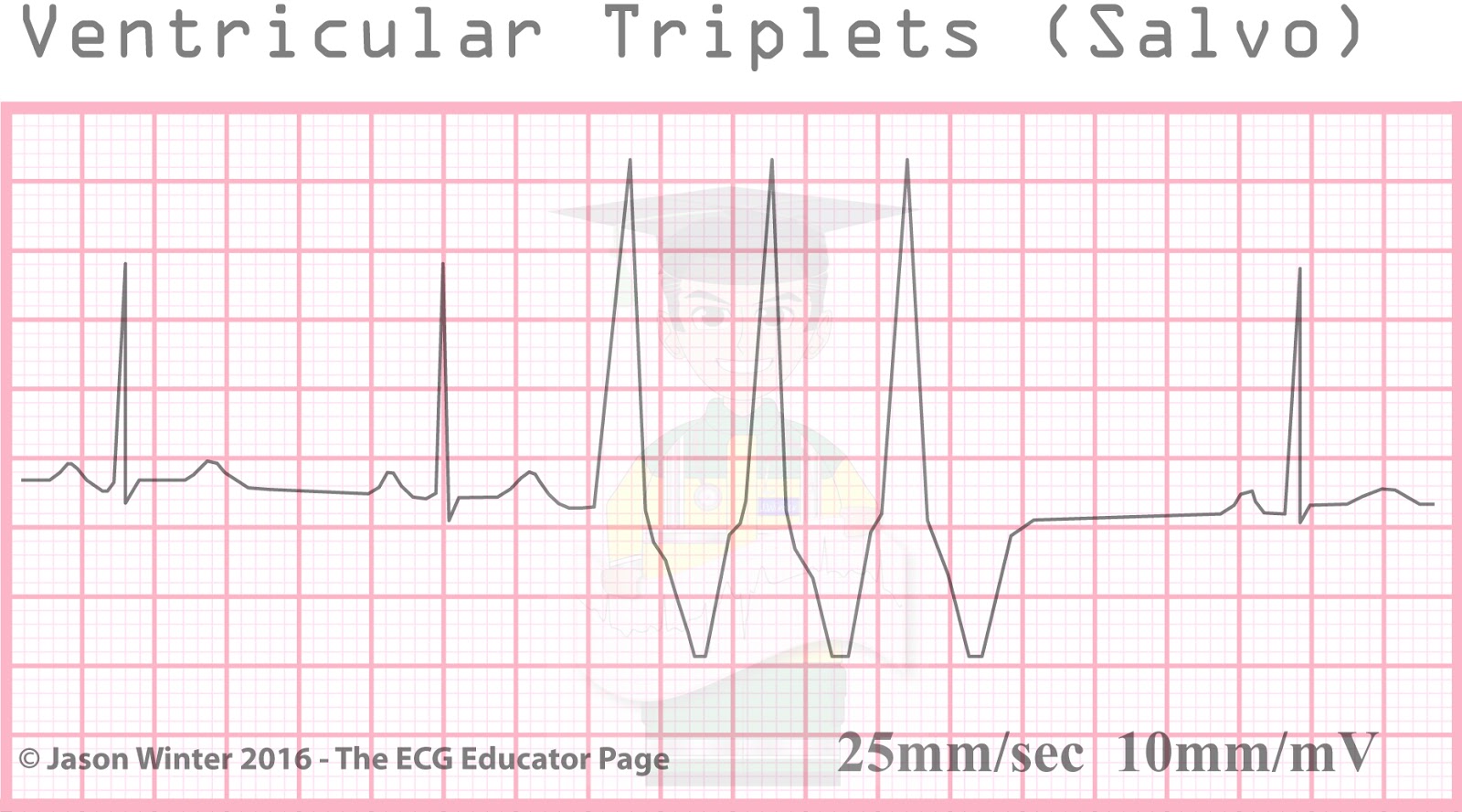 ECG Educator Blog : Ventricular Ectopics