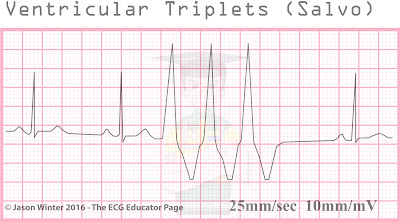 ECG Educator Blog : Ventricular Ectopics