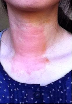 Medical Treatment Pictures-for Better Understanding: Lymphoma of Skin ...