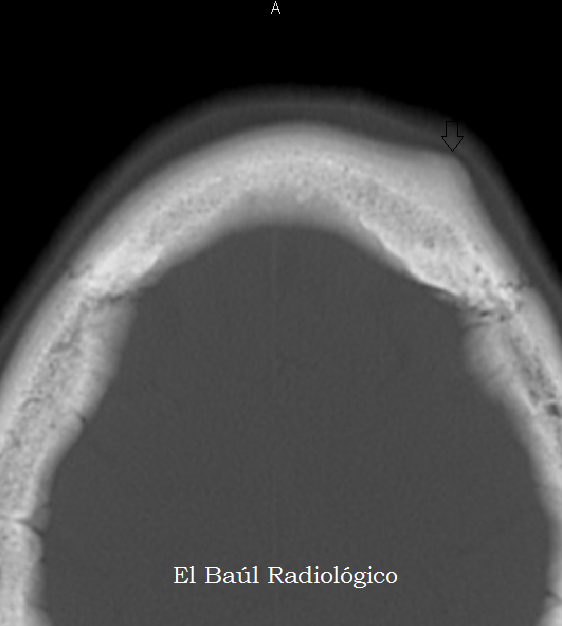 El Baúl Radiológico: OSTEOMAS CRANEALES. (Cranial Osteomas. CT Findings ...