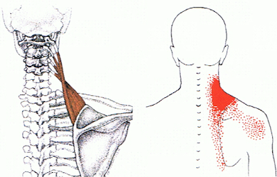 Ideal Balance Acupuncture: Levator Scapula Neck Pain