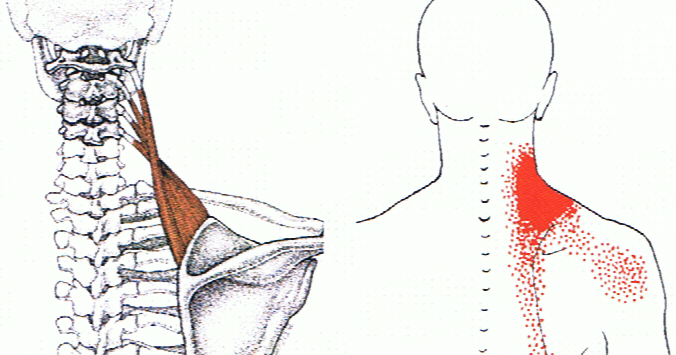 Ideal Balance Acupuncture: Levator Scapula Neck Pain