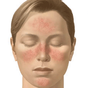 Never too late to turn back: Vamos falar de rosácea?