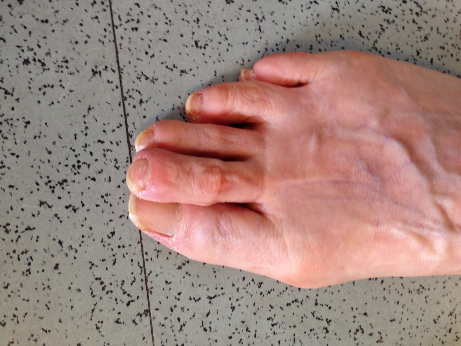 Foot and Ankle Problems By Dr. Richard Blake: Hammertoe Video